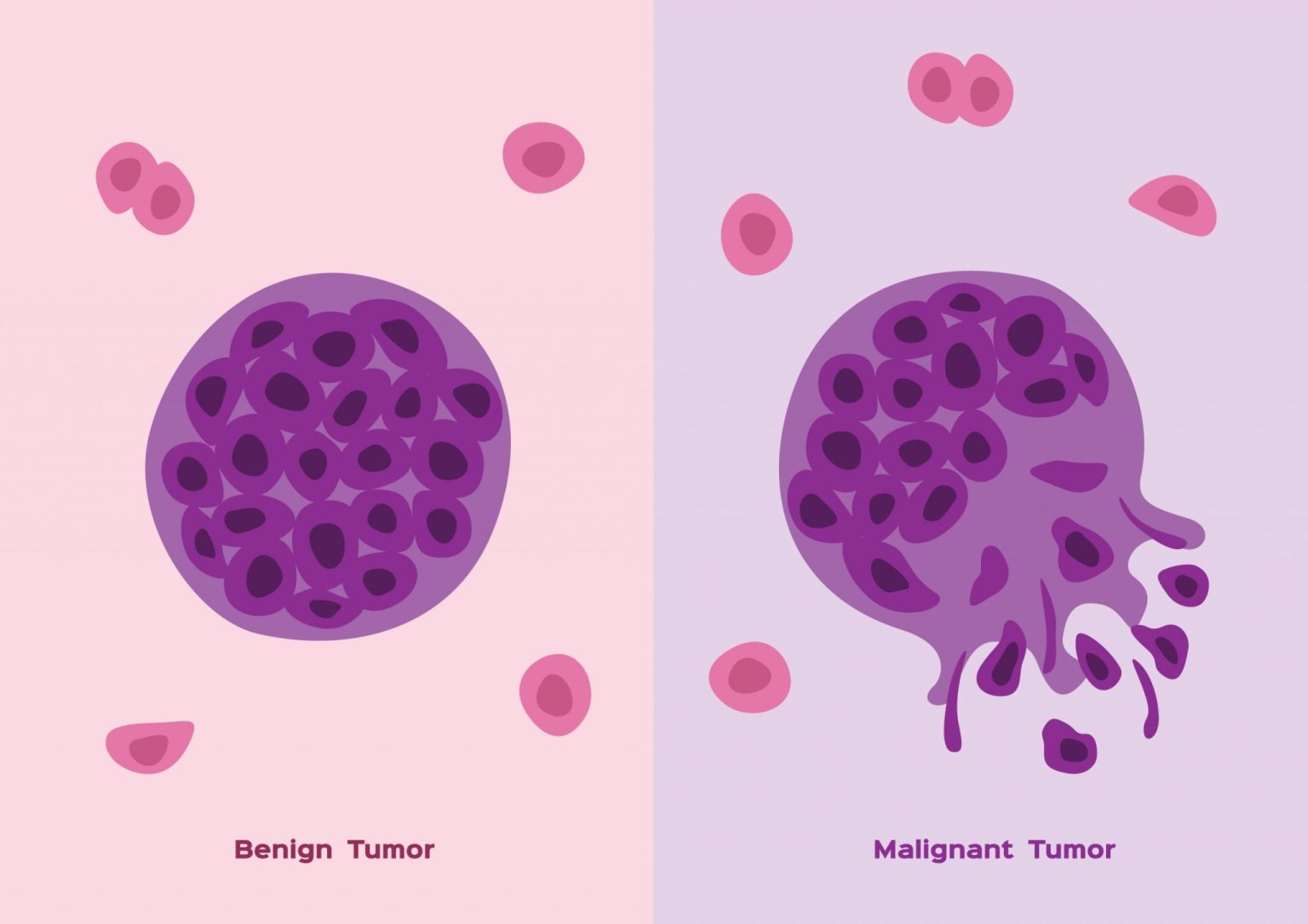 Differences Between Benign and Malignant Tumors